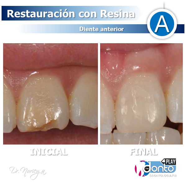 Resina Diente Anterior :: OdontologiaFM
