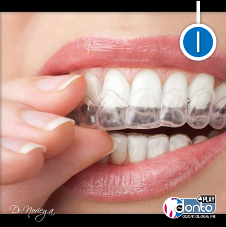 Guarda Ferula Oclusal_9.png :: OdontologiaFM